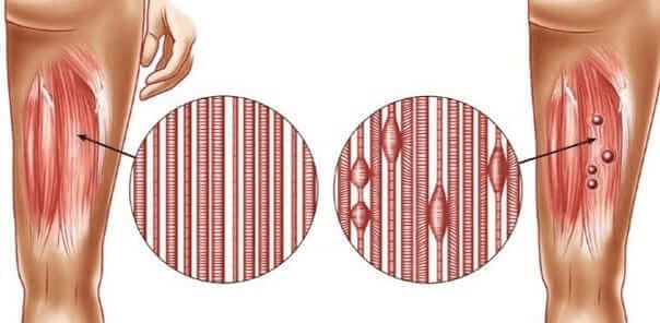 Shockwave therapy - Acoustic Wave Therapy - Bend Spinal Care